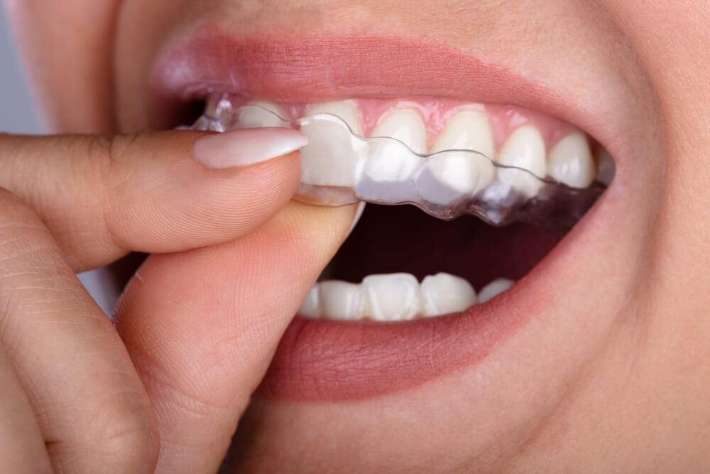 Post-Op Instructions for Clarity Aligners | Kuzmic Orthodontics ...